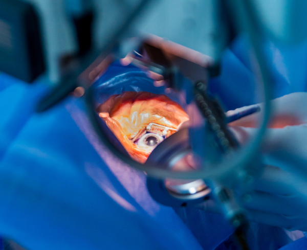 Eye Surgery – Daaniyal